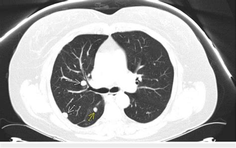 Chest Ct Scan 102015 Showed Pulmonary Nodules Increased In Size