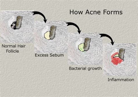 Formation Of Acne Genetic Vs Environmental Causes Owlcation