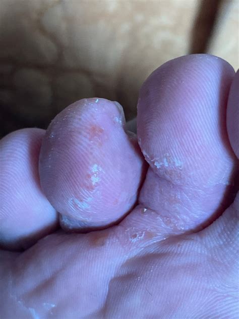 이게뭔가요발가락에물집 지식in