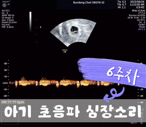 임신 6주차 증상 아기 초음파 심장소리 산부인과 임신확인서 발급 네이버 블로그