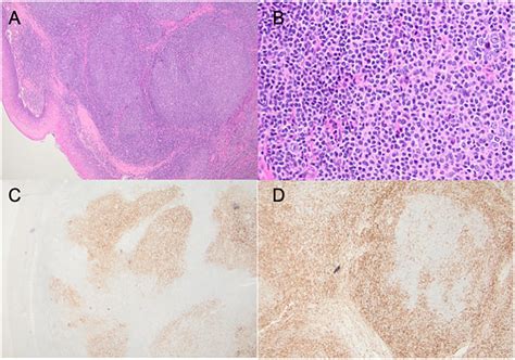 Benign Follicular Hyperplasia With Clonal B Cell Expansion An Uncommon
