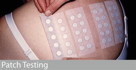 Patch Testing With Dr David Orton London Allergy Doctor