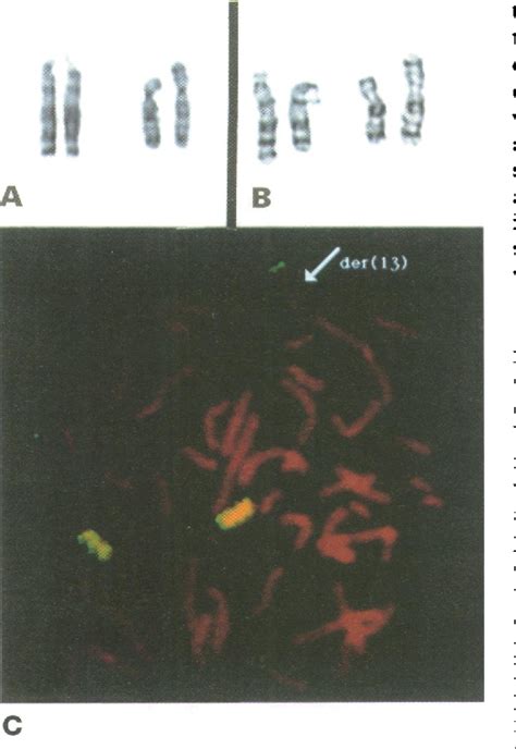 Figure 1 From A Case Of Duplication Of 13q32 Qter And Deletion Of 18p