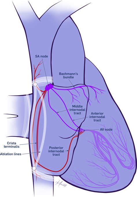 Sinus Node Sparing Novel Hybrid Approach For Treatment Of Inappropriate