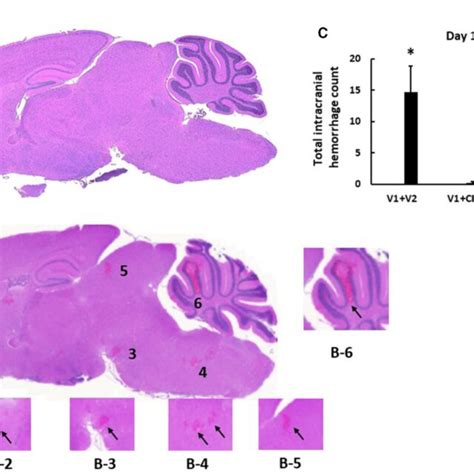 Figure Cip Therapy With Peg Mitigates Intracranial Hemorrhagic Lesions