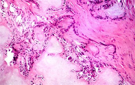 Gout Tophus Photomicrograph Showing Amorphous Eosinophilic Material
