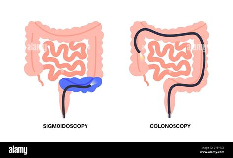 Conceptual Illustration Of Colonoscopy And Sigmoidoscopy Procedures