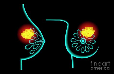 Female Breast Cancer 12 By Science Photo Library