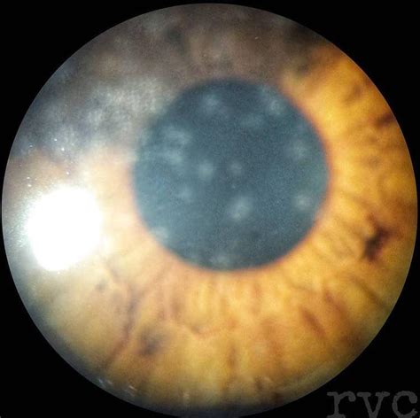Nummular Keratitis • Ophthalmology Notes And Synopses Facebook