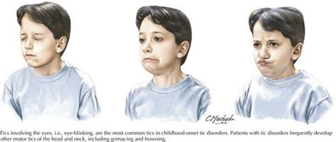Tic Disorders Clinical Gate
