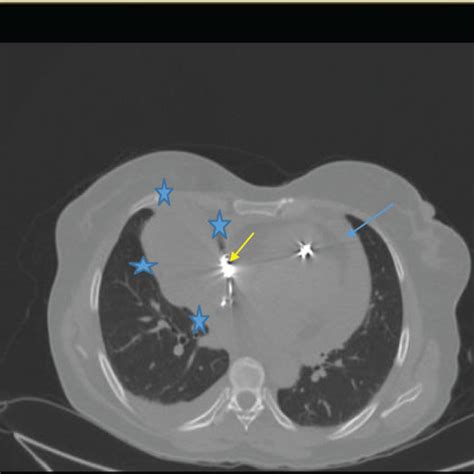 A Chest X Ray Immediately Following Pacemaker Insertion Procedure Download Scientific Diagram