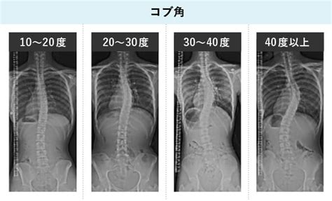 子どもの姿勢改善と側弯症 きのて整体院 天白平針日進赤池緑区徳重神の倉で口コミ人気