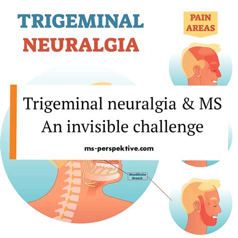 Trigeminal Neuralgia And Ms An Invisible Challenge