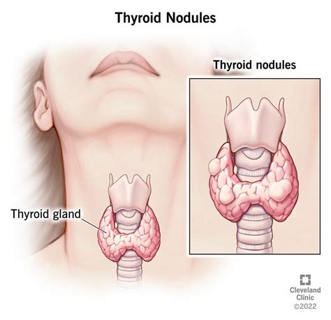 Thyroid Nodules Why Do I Have Thyroid Nodules Rfa For Life Blog