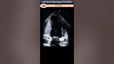 Left Atrial Appendage Tte And Tee Youtube