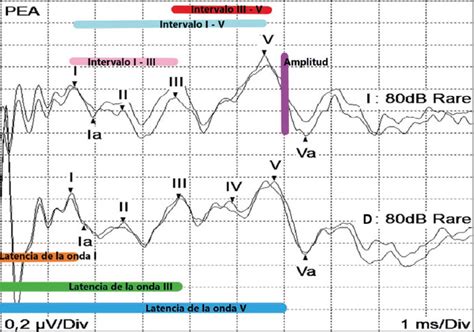 Findings In Brainstem Auditory Evoked Potentials In Patients Under 2