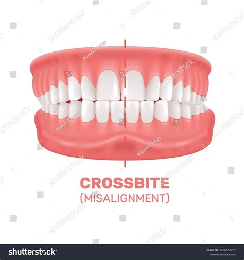 Malocclusion Teeth Infographics Crosebite Teeth Misalignment Stock