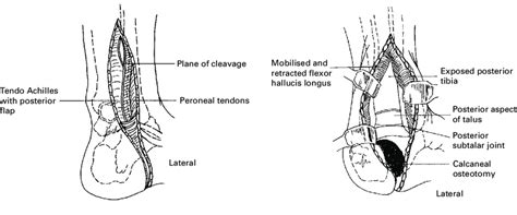 Osteotomy Of Os Calcis Posterior To The Subtalar Joint Download Scientific Diagram