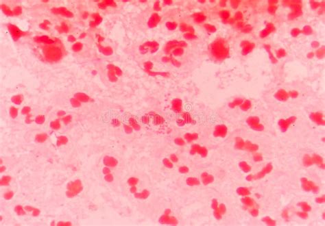 Gram Negative Diplococci