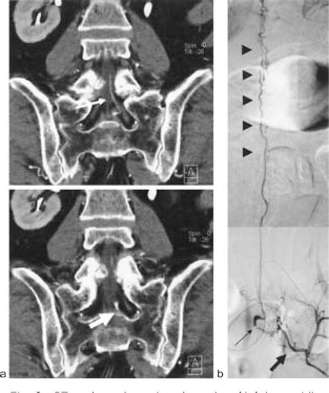 Figure 2 From Multidetector Row Helical Ctmdctをもちいたct Angiography が流入