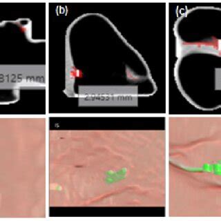 Step By Step Result Of Polyp Measurement A Original Axial Slice Download Scientific Diagram