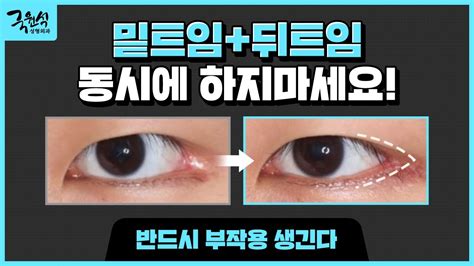 밑트임 뒤트임 동시에 하지마세요 Youtube