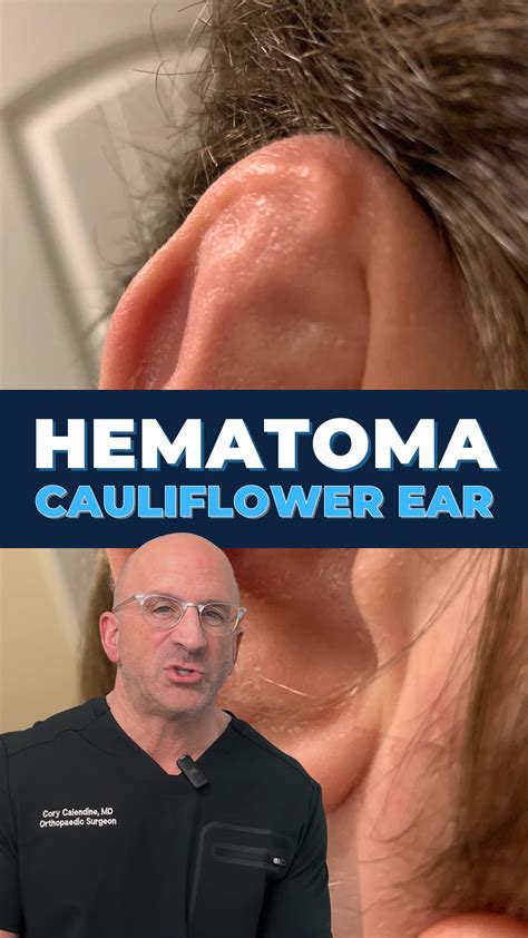 Understanding Cauliflower Ear Risks And Treatments Tiktok