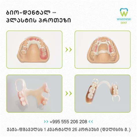 🦷 ნაწილობრივი ვიაზოვსკი დენტი • Wiazowski Dent Facebook