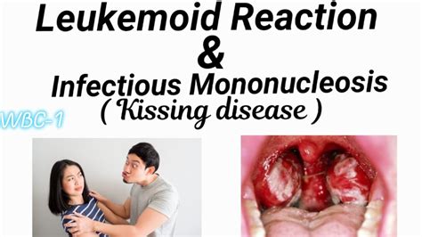 Leukemoid Reaction And Infectious Mononucleosis Kissing Disease Wbc 1 Youtube