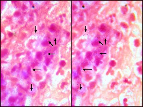 Fun With Microbiology Whats Buggin You Mycobacterium Tuberculosis