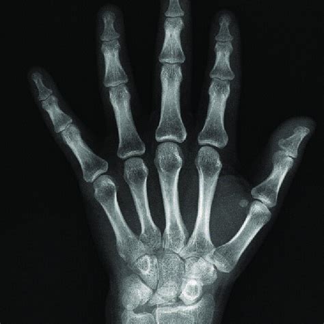 Kienbocks Disease Stage 3b The Collapse Of Lunate Fixed Scaphoid
