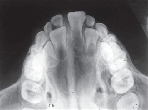 Occlusal Radiograph 6 Buyxraysonline