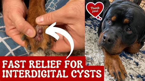 Fast Relief For Interdigital Cysts Youtube