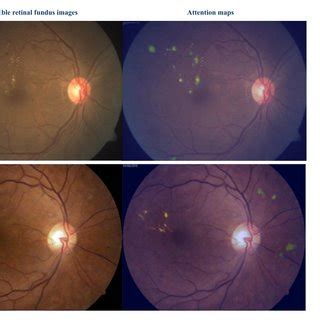 Deep Learning Based Automated Retinal Image Analysis System A