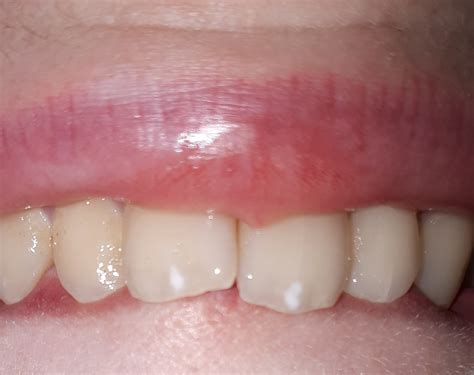 Белые пятна на зубах Белые пятна на зубах что это может быть Как можно Medaboutme