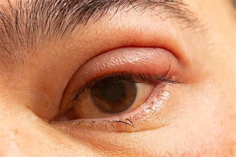 Coding For Blepharitis An Infectious Eye Disorder