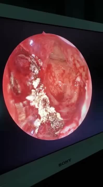 [video] Francesco Faiella On Linkedin Treatment Of Frontoethmoidal Mucocele With Orbital