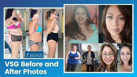 What Is Vsg Surgery Vertical Sleeve Gastrectomy In Mexico