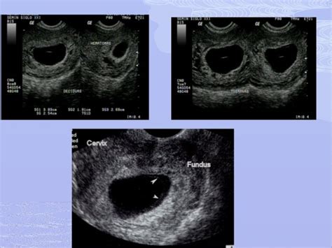 Embarazo Anembriónico