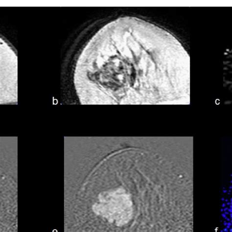 Example Of Mri Findings Of A Previous Birads 3 Examination A Download Scientific Diagram