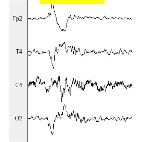 Pdf A Matlab Software For Detection And Counting Of Epileptic Seizures In 72 Hours Holter Eeg