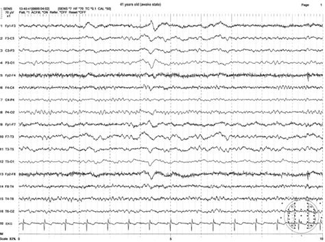 Post Stroke Epilepsy Pse Neuro Pathway