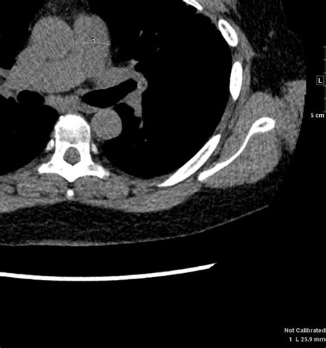 197lu Sle Nsip Probable Fibrotic Pattern Lungs