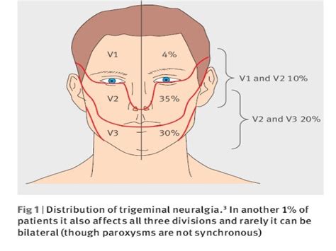 Trigeminal Neuralgia