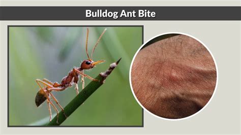 13 Types Of Ant Bites Symptoms Reaction Identification With Pictures