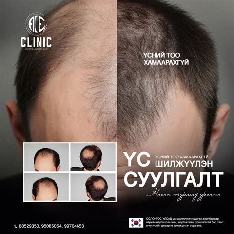 Ace НАСАН ТУРШИД УРГАХ ҮС ШИЛЖҮҮЛЭН СУУЛГАЛТ 👨 Уртаар нь суулгана