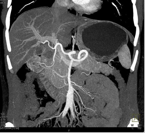 Gist Duodenum Small Bowel Radiology Case Studies Ctisus Ct Scanning