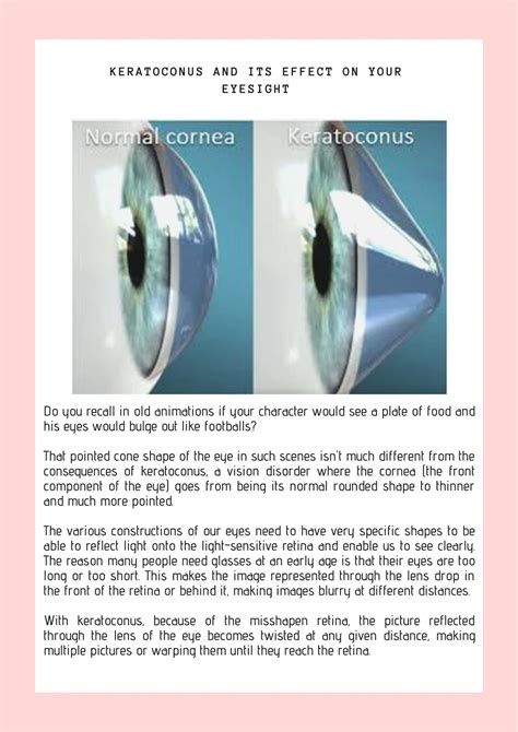 Ppt Keratoconus And How Does It Affect Your Eyesight Powerpoint