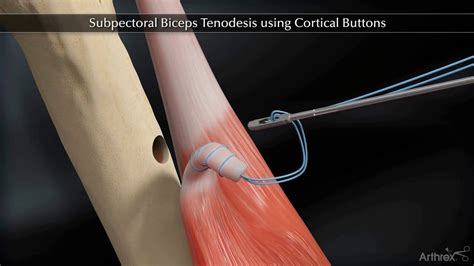 Subpectoral Biceps Tenodesis Using Cortical Buttons Youtube