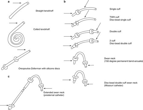 Operative Considerations For Peritoneal Dialysis Catheter Springerlink